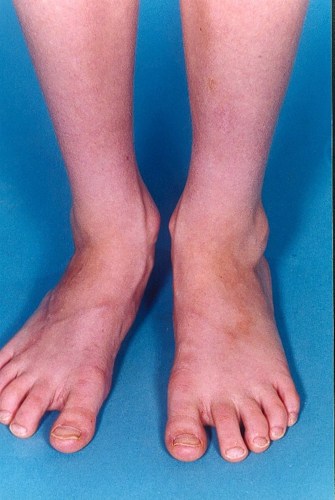 Scleroderma Nurse Pmm